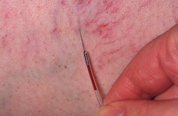 Thread Veins and Microsclerotherapy » The Vein Clinic